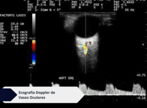 Ecografía Doppler de Vasos Oculares - Ecodoppler Vascular