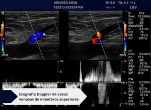 Ecografía Doppler de vasos venosos de miembros superiores