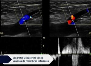 Ecografía Doppler de vasos venosos de miembros inferiores